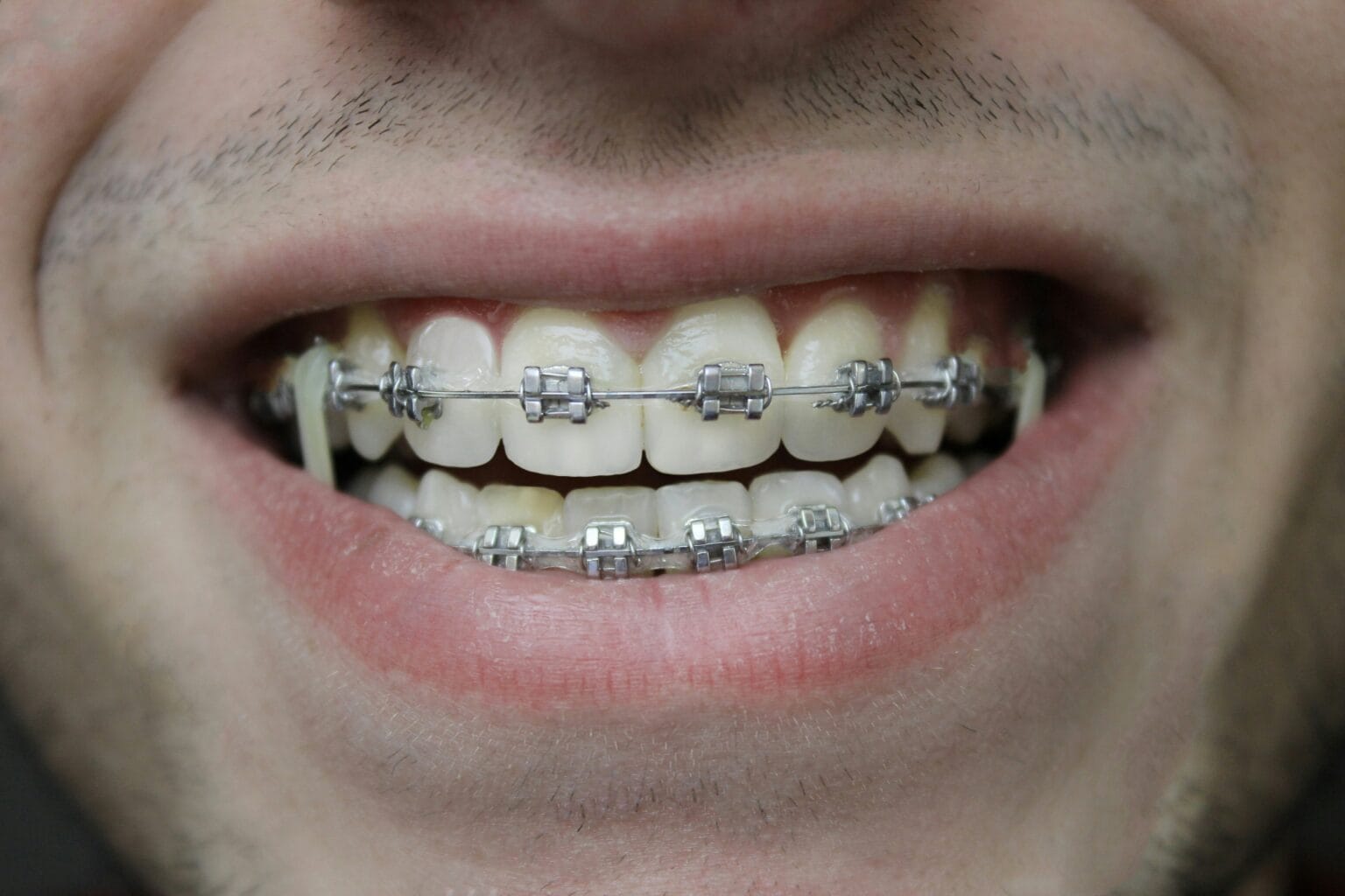 How Long Do You Have to Wear Dental Braces