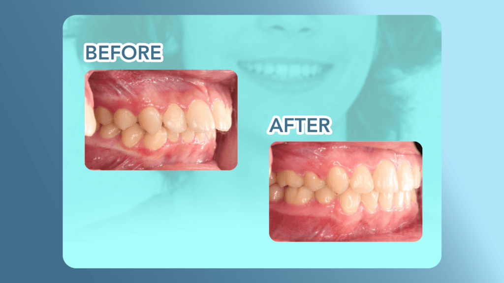 Overjet Before And After Results From Washington Orthodontics Overjet Before And After Results From Washington Orthodontics